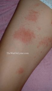 Rashes and Lyme Disease • The War on Lyme